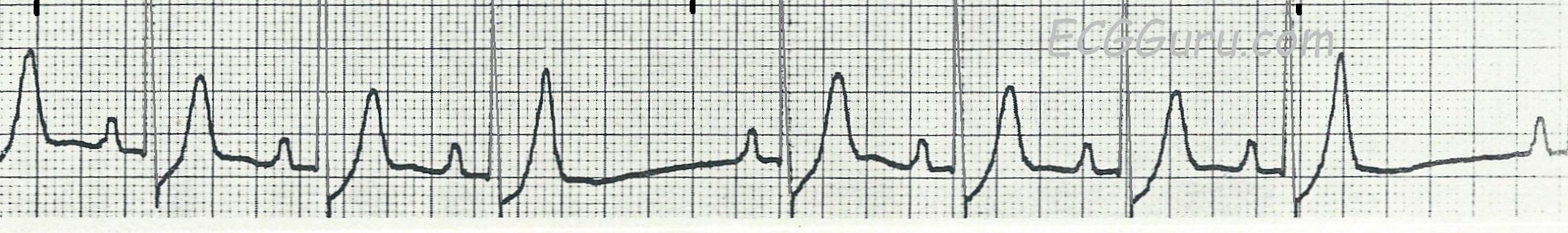 ECG Basics Sinus Rhythm With Non Conducted PACs ECG Guru ecg-basics-sinus-rhythm-with-non-conducted-pacs-ecg-guru